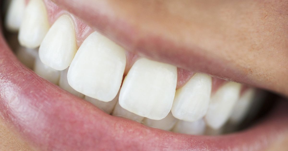 What’s An Overbite? Signs, Causes, & Treatments - Orthodonticscolorado.com