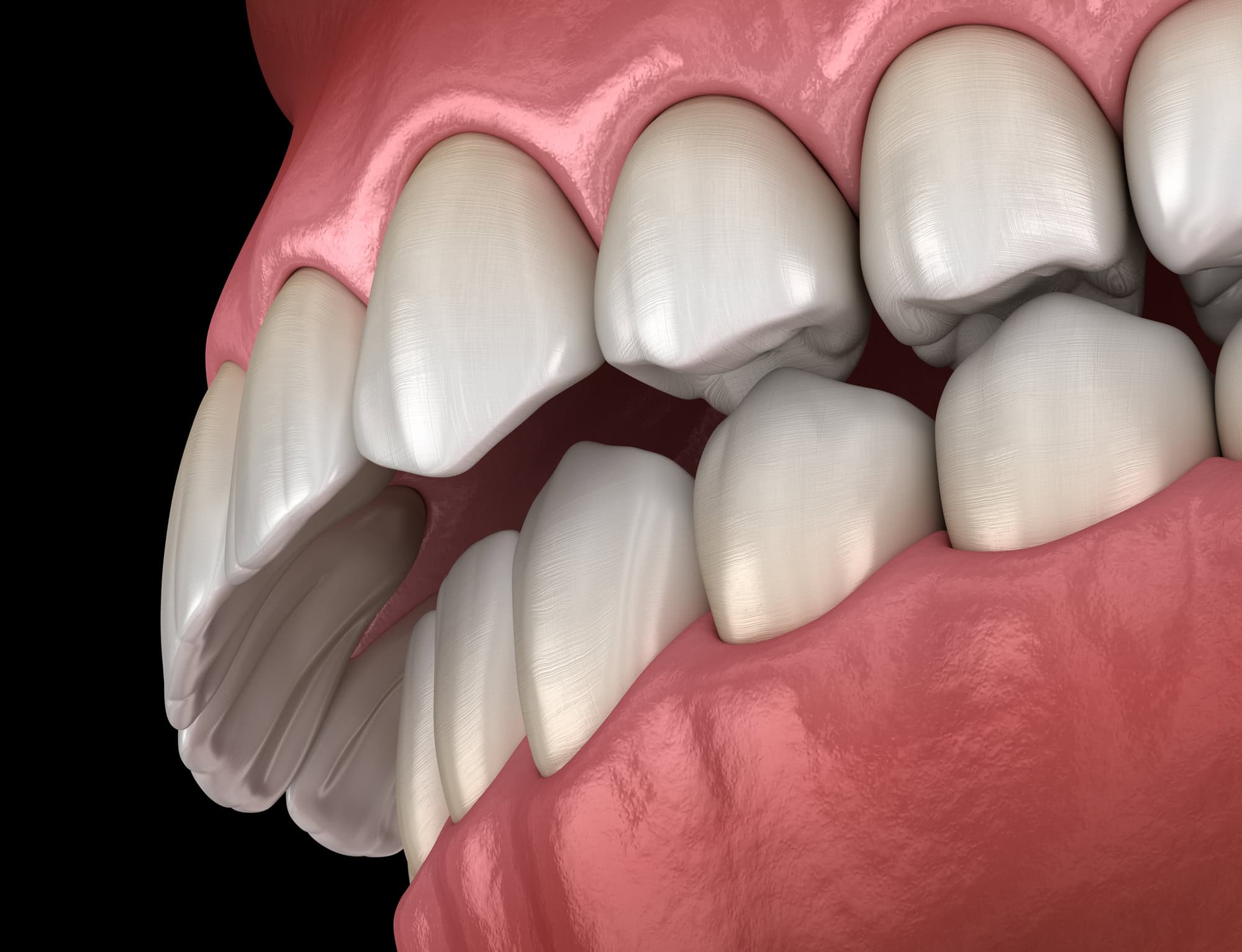 What’s An Overbite? Signs, Causes, & Treatments - Orthodonticscolorado.com